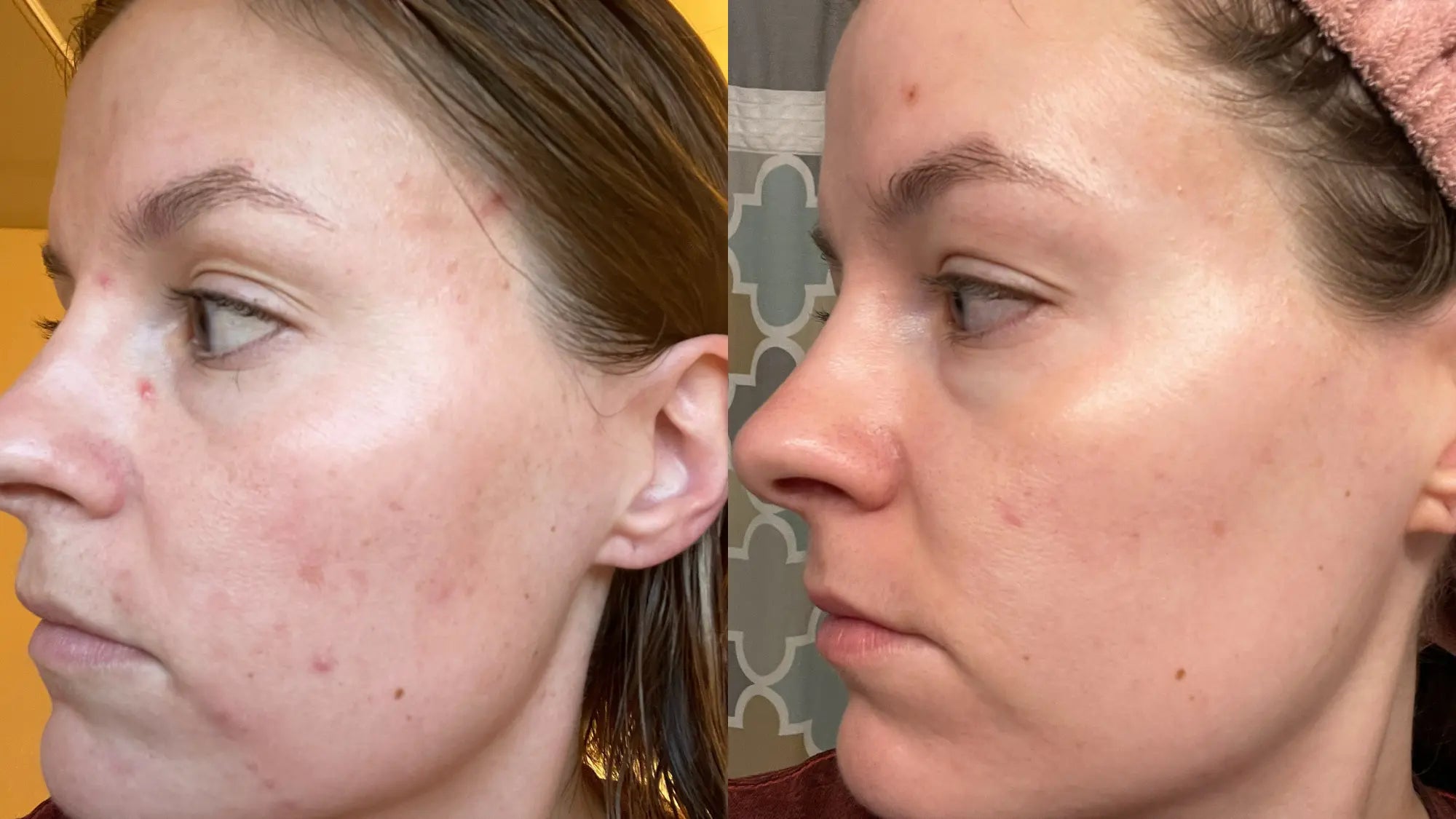 Megan’s Clear Skin Transformation: A Success Story – Art of Skin Care