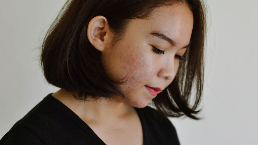 How to Treat Post-Inflammatory Hyperpigmentation (PIH) Acne